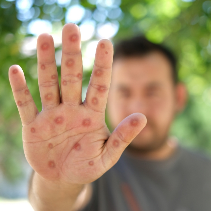 Do you know about MPOX or monkeypox? - Triple-S Blog